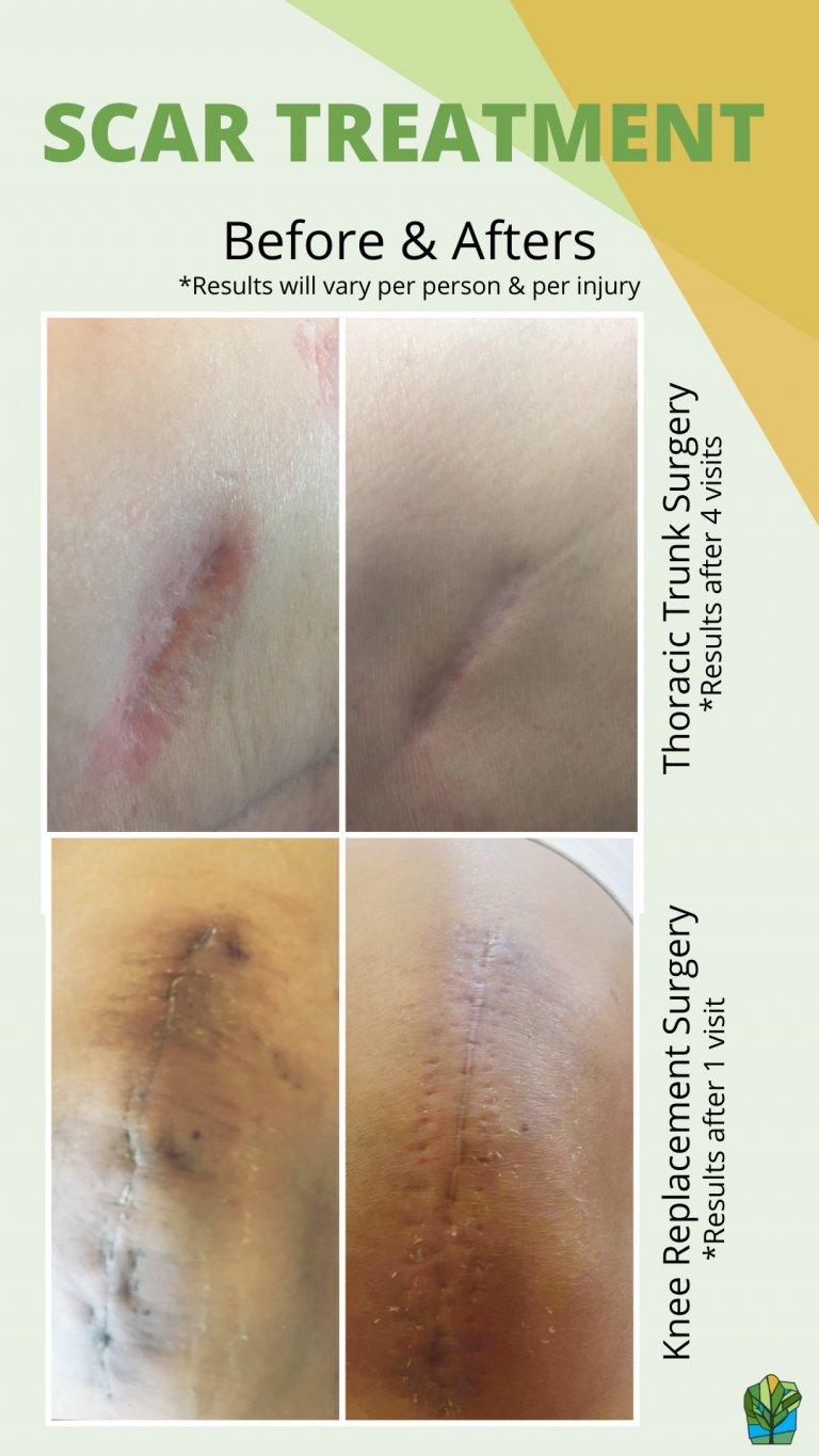 Scar Release Treatment (Dolphin Neurostim) – HOPE Physical Therapy ...